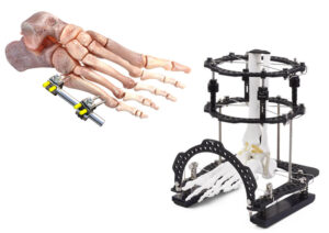 External Fixators - Fuse Medical