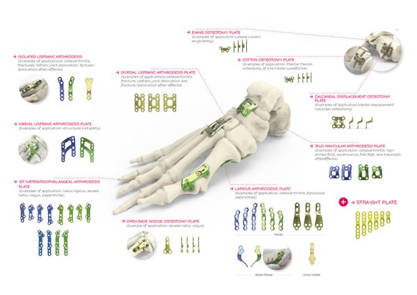 Foot Plating Systems - Fuse Medical