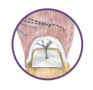 Rotium - Fuse Medical