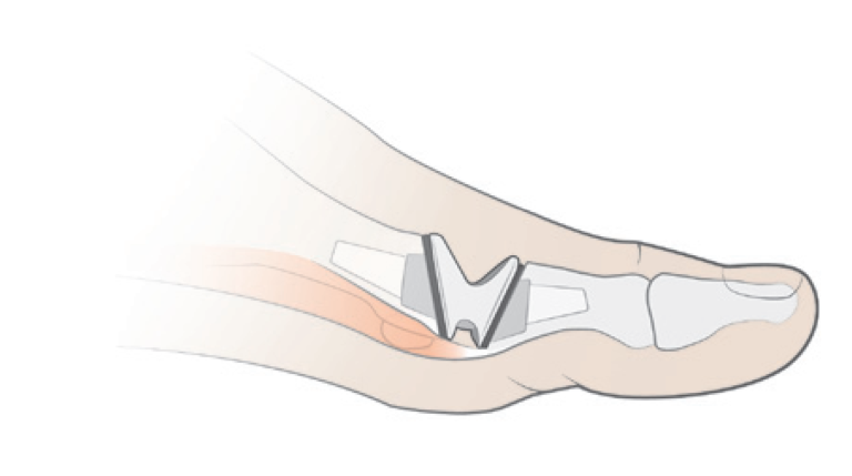 Silktoe Silastic MPJ Arthroplasty - Fuse Medical